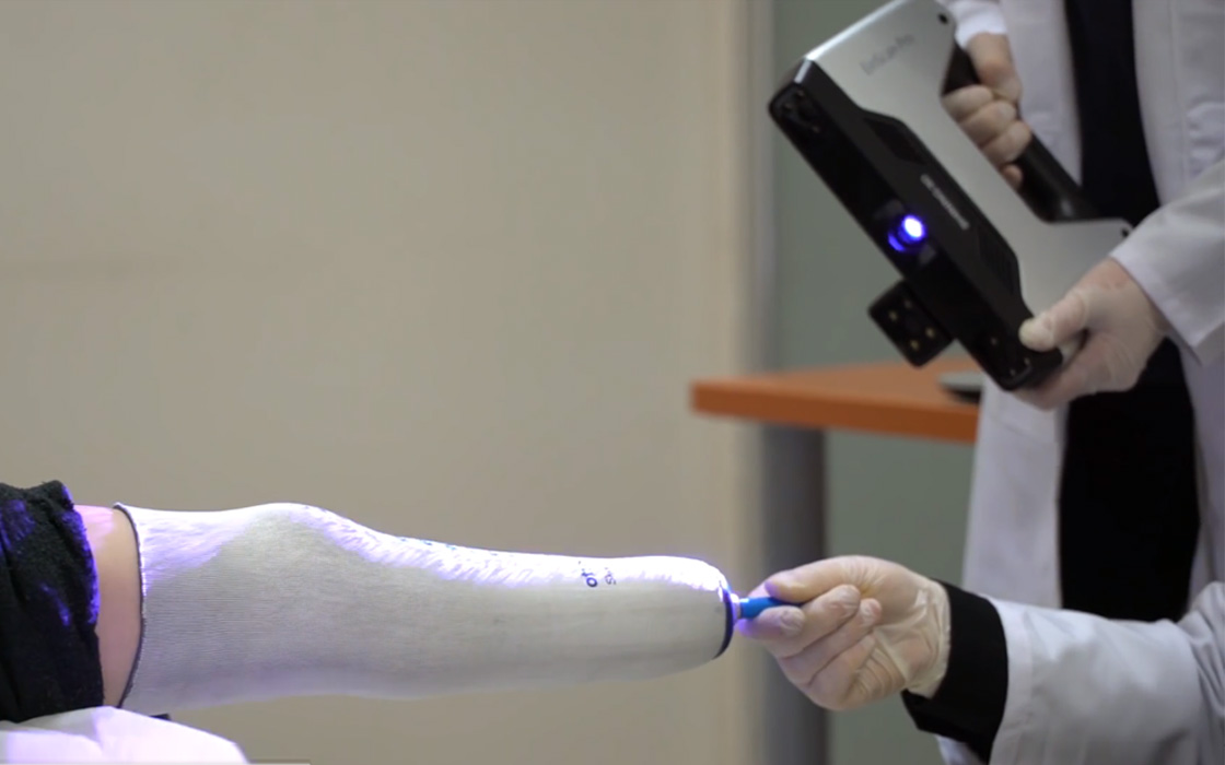 Orthotic Repair for Disabled Syrian Children by Using EinScan-Pro 3D ...