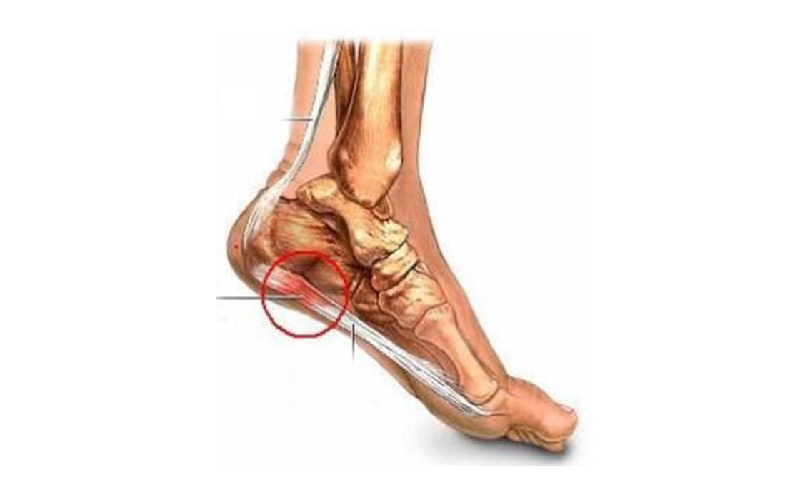 EinScan-Pro applied in the research of 3D printing individualized heel cup
