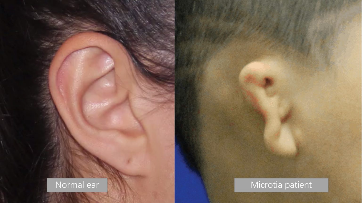 Using 3D Scan to 3D Print for Microtia Reconstruction - EinScan