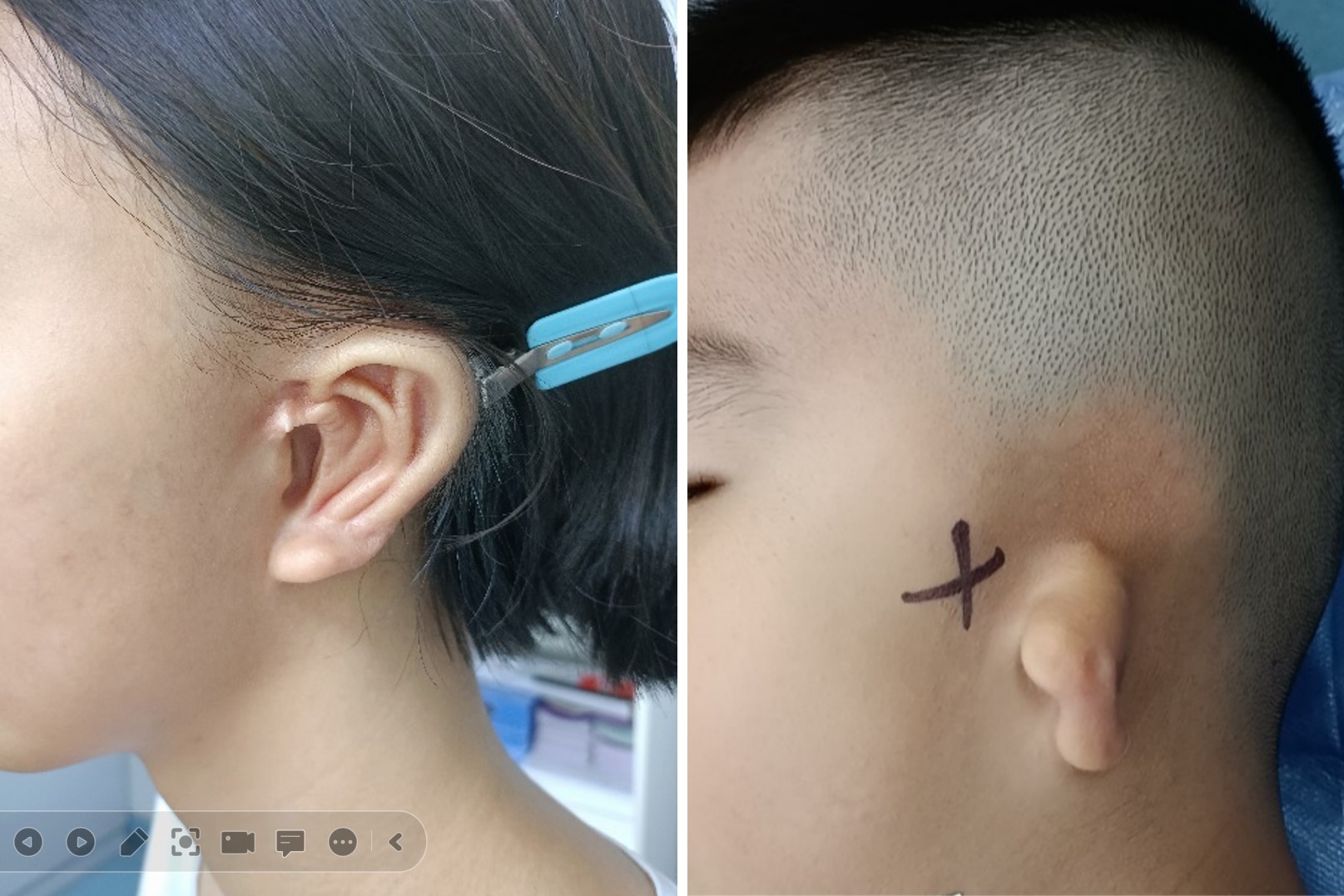 Using 3D Scan to 3D Print for Microtia Reconstruction - EinScan