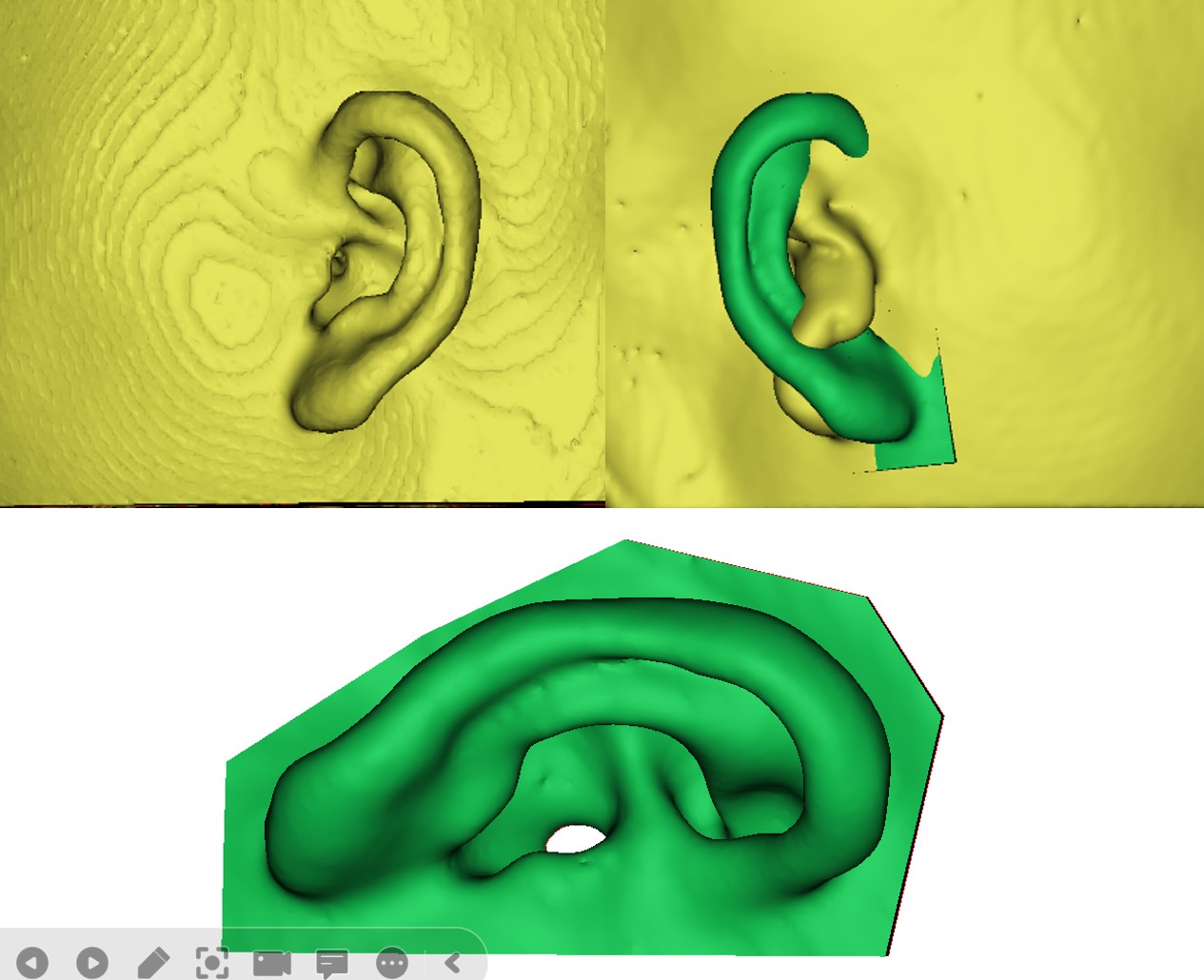 Using 3D Scan to 3D Print for Microtia Reconstruction - EinScan