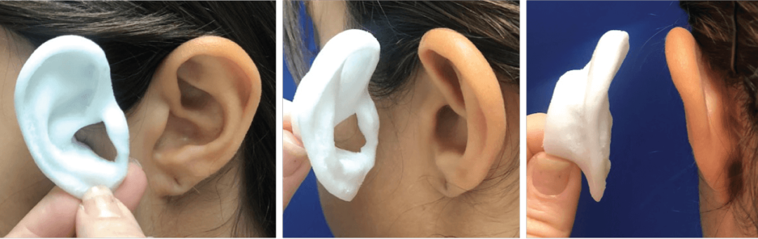 Using 3D Scan to 3D Print for Microtia Reconstruction - EinScan