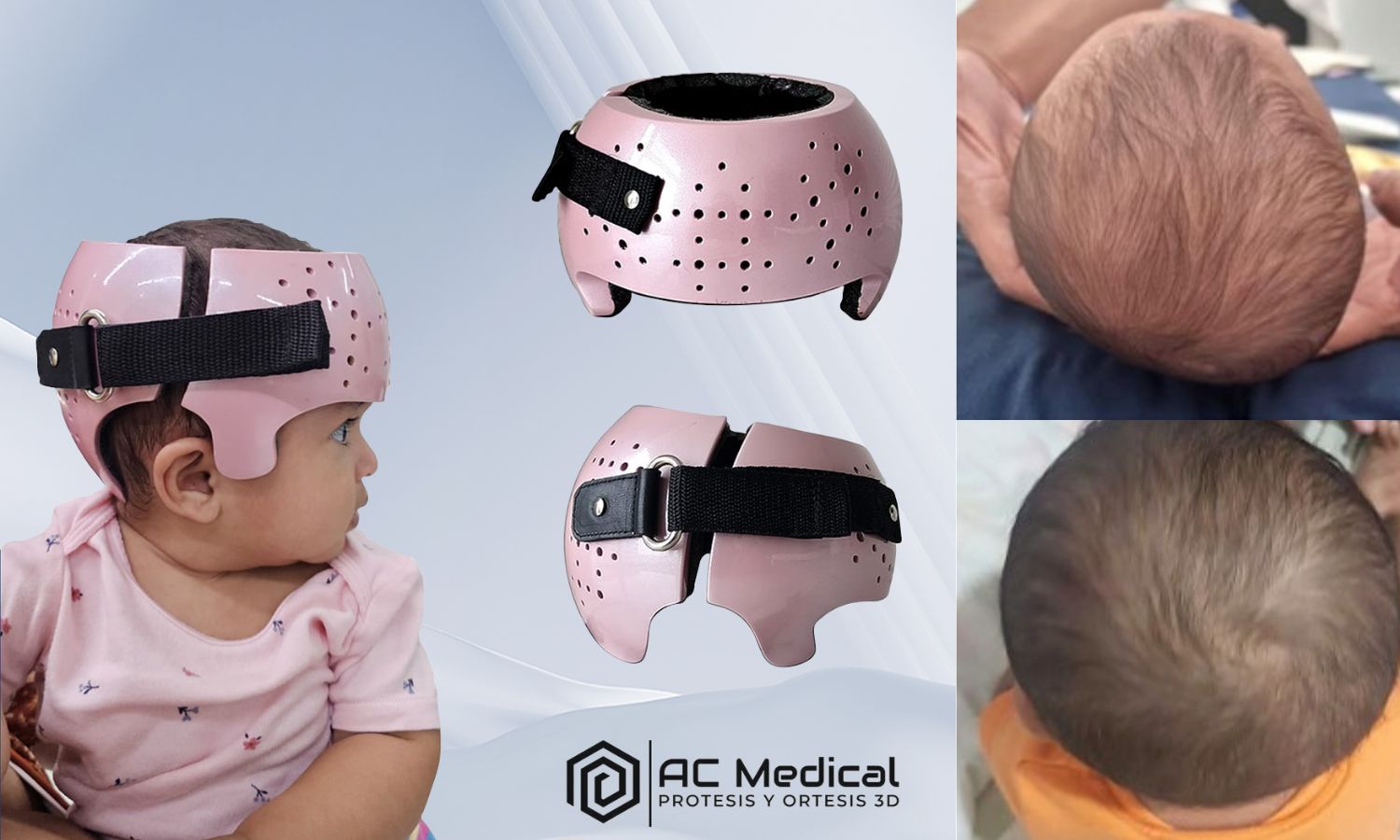 Customizing Cranial Orthotic Helmets with 3D Scanner and Printer